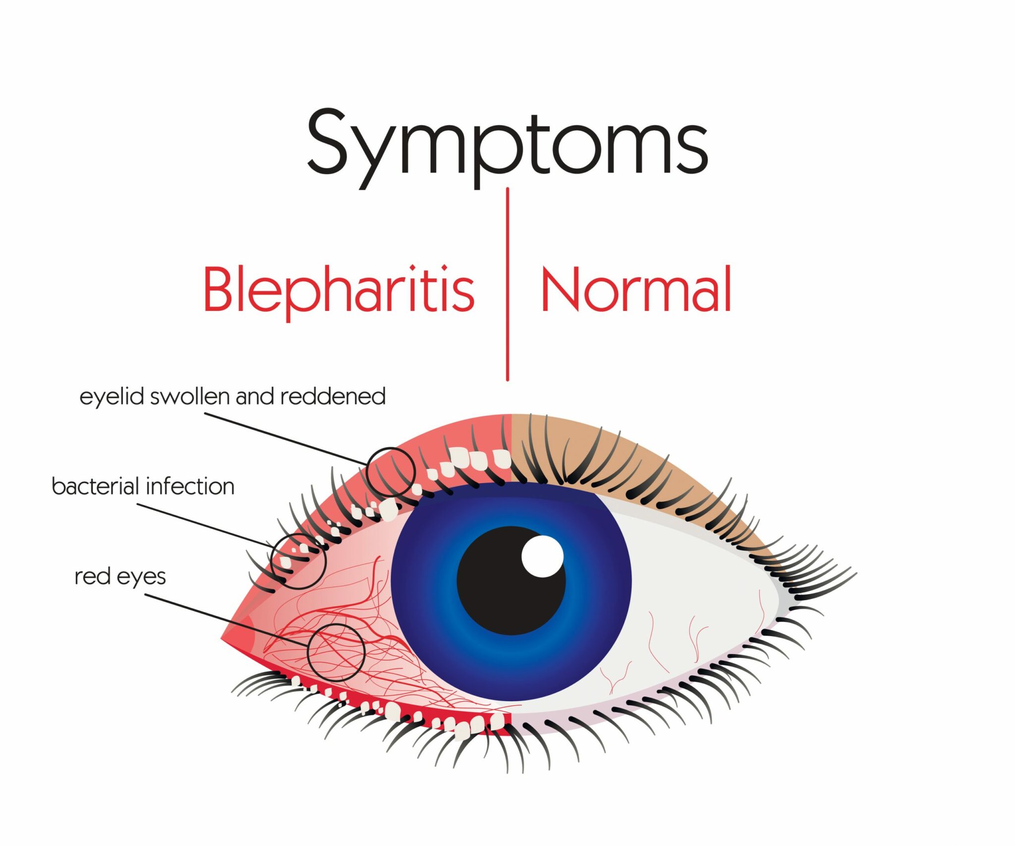What is BlephEx, and is it Right for Me? | Eye Physicians of Long Beach