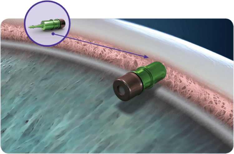 iDose Clinical Trial with Travoprost Implant | Glaucoma Long Beach