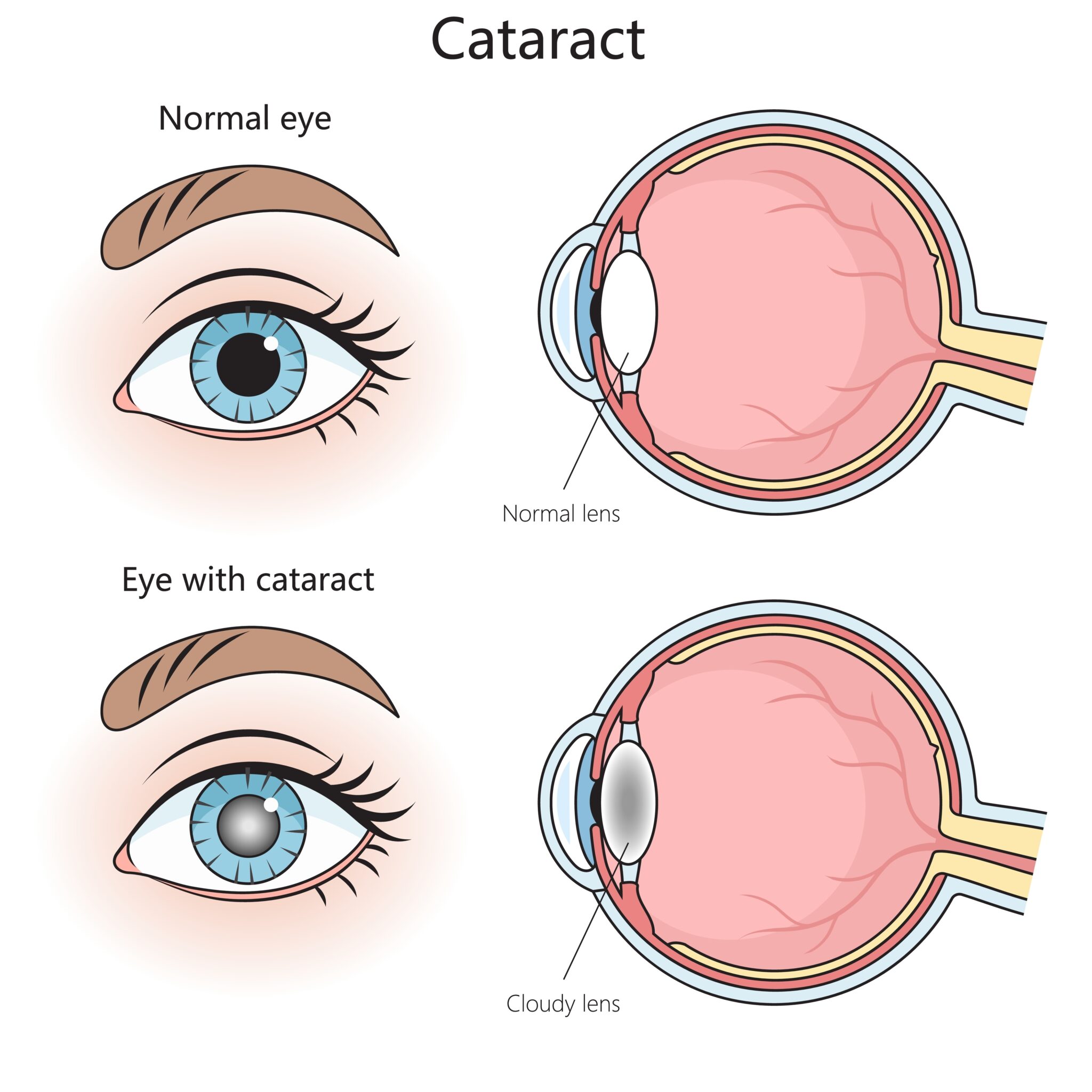 What are the Most Common Symptoms of Cataracts? | Eye Physicians of ...
